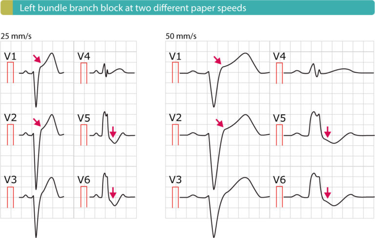 ST segment elevation in acute myocardial ischemia and differential ...