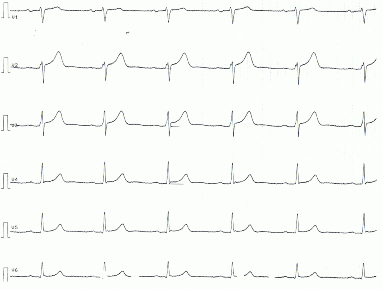 Pericarditis, myocarditis & perimyocarditis: ECG, criteria & treatment