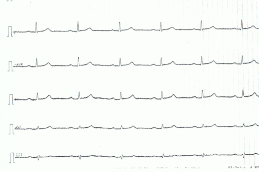 Pericarditis, myocarditis & perimyocarditis: ECG, criteria & treatment