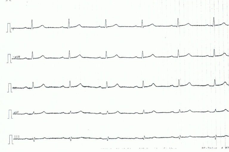 Pericarditis, myocarditis & perimyocarditis: ECG, criteria & treatment