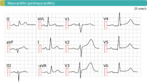 Pericarditis, myocarditis & perimyocarditis: ECG, criteria & treatment