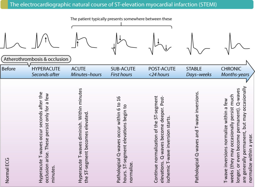 ST segment elevation in acute myocardial ischemia and differential ...