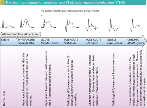 ST segment elevation in acute myocardial ischemia and differential ...