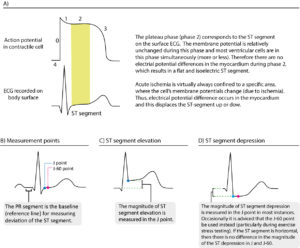 ECG in myocardial ischemia: ischemic changes in the ST segment & T-wave