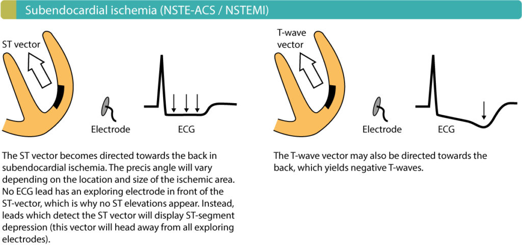 ECG in myocardial ischemia: ischemic changes in the ST segment & T-wave