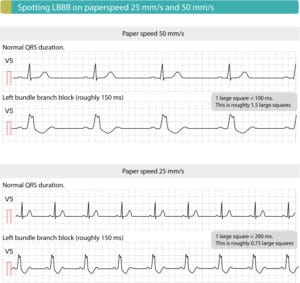 Left bundle branch block (LBBB): ECG criteria, causes, management