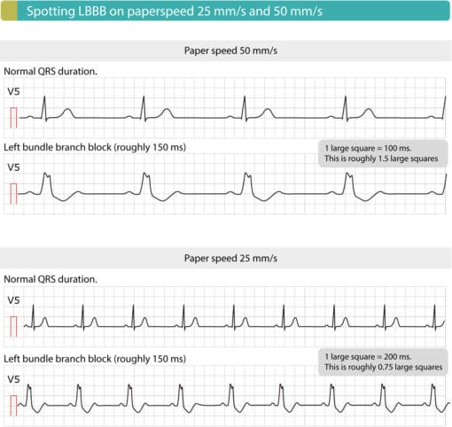 Left bundle branch block (LBBB): ECG criteria, causes, management