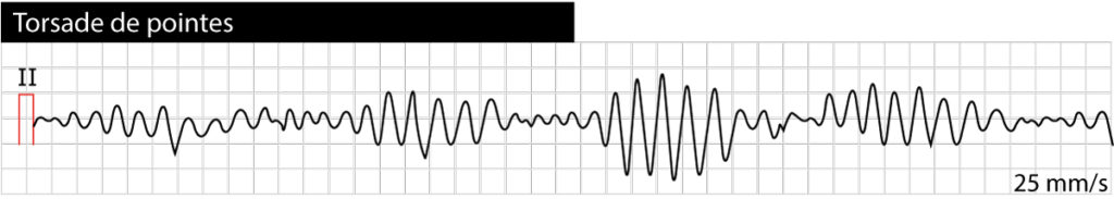 Figure 2. Torsade de pointes (polymorphic ventricular tachycardia ...