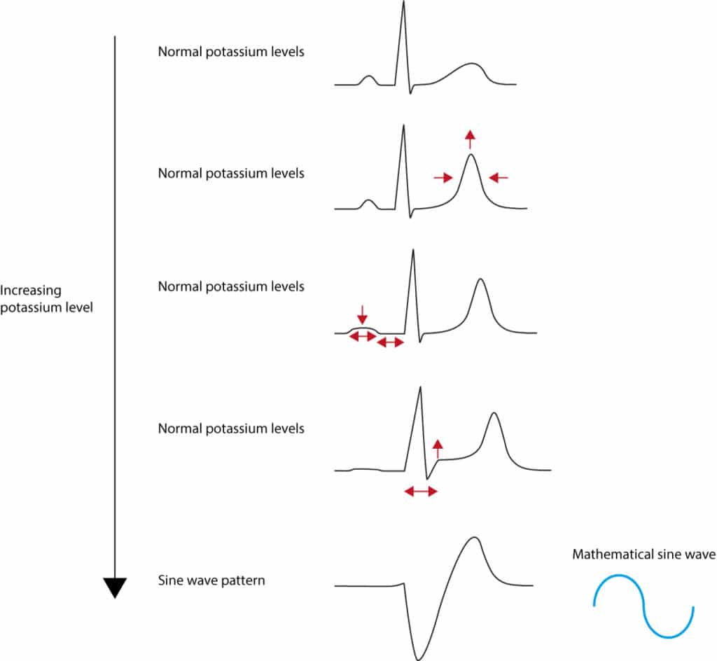 Figure 1. ECG changes seen in hyperkalaemia. – The Cardiovascular