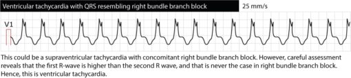 Ventricular tachycardia (VT): ECG criteria, causes, classification ...