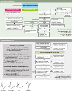 Diagnosis and management of narrow and wide complex tachycardia
