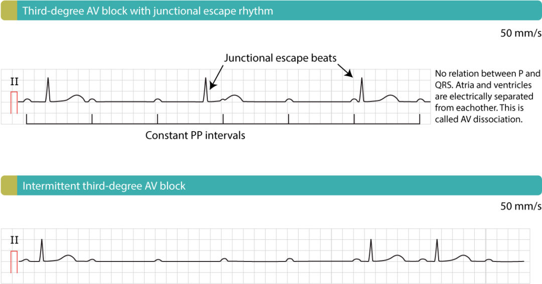 Figure 1. Third-degree AV block (complete heart block, AV dissociation ...