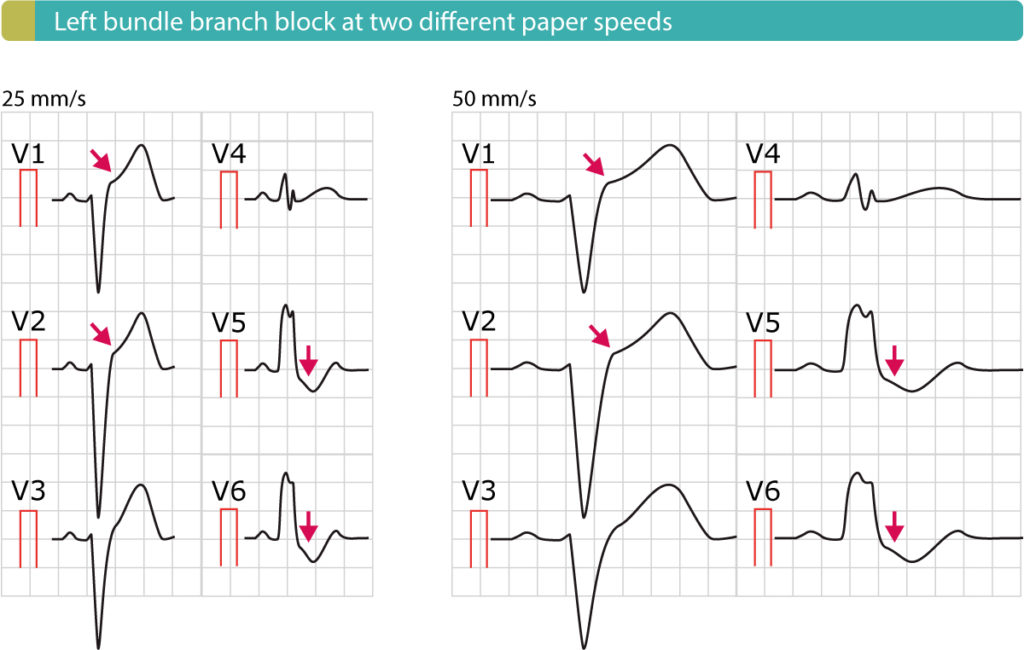 Figure 3. Left bundle branch block (LBBB). – The Cardiovascular