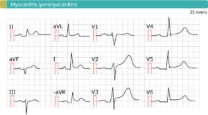 ST segment elevation in acute myocardial ischemia and differential diagnoses