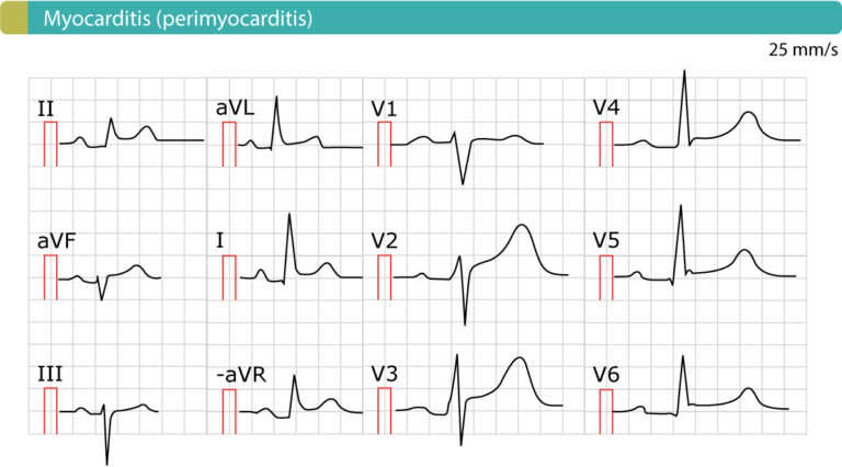 ST segment elevation in acute myocardial ischemia and differential ...