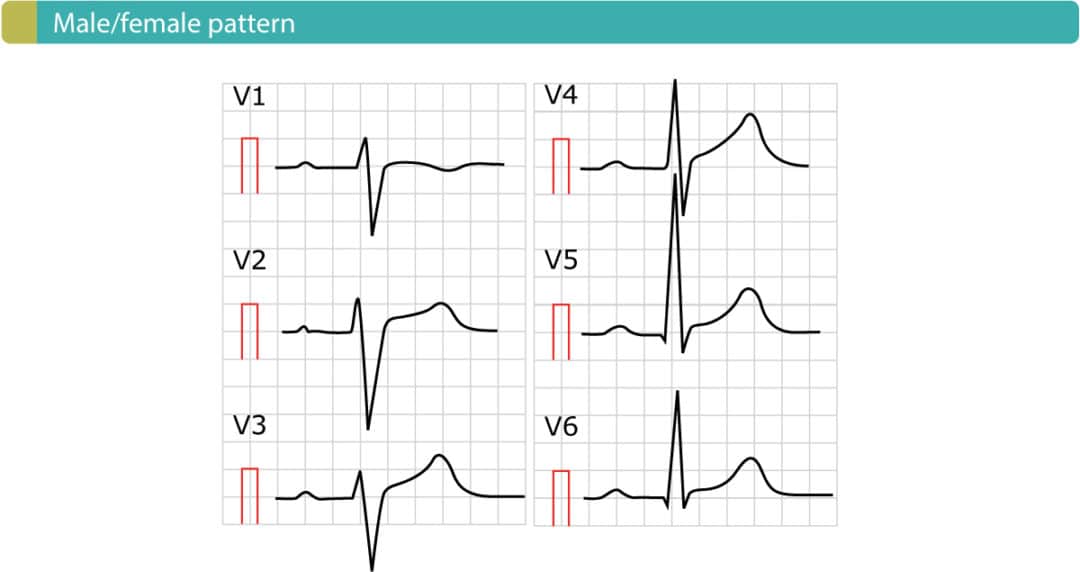 Figure 3. Male/female pattern. Also called “normal ST segment elevation ...