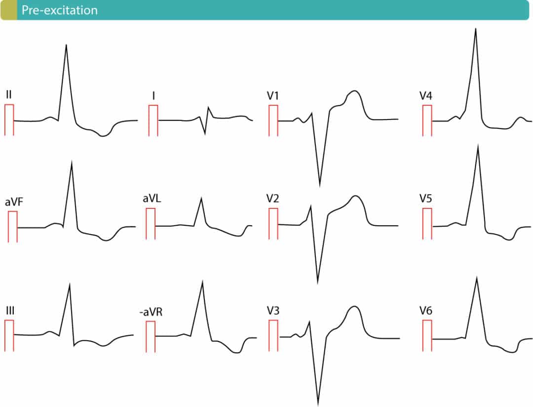 ST segment elevation in acute myocardial ischemia and differential ...