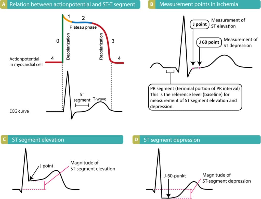 Figure 1. (A) The relation between the action potential and the ECG ...