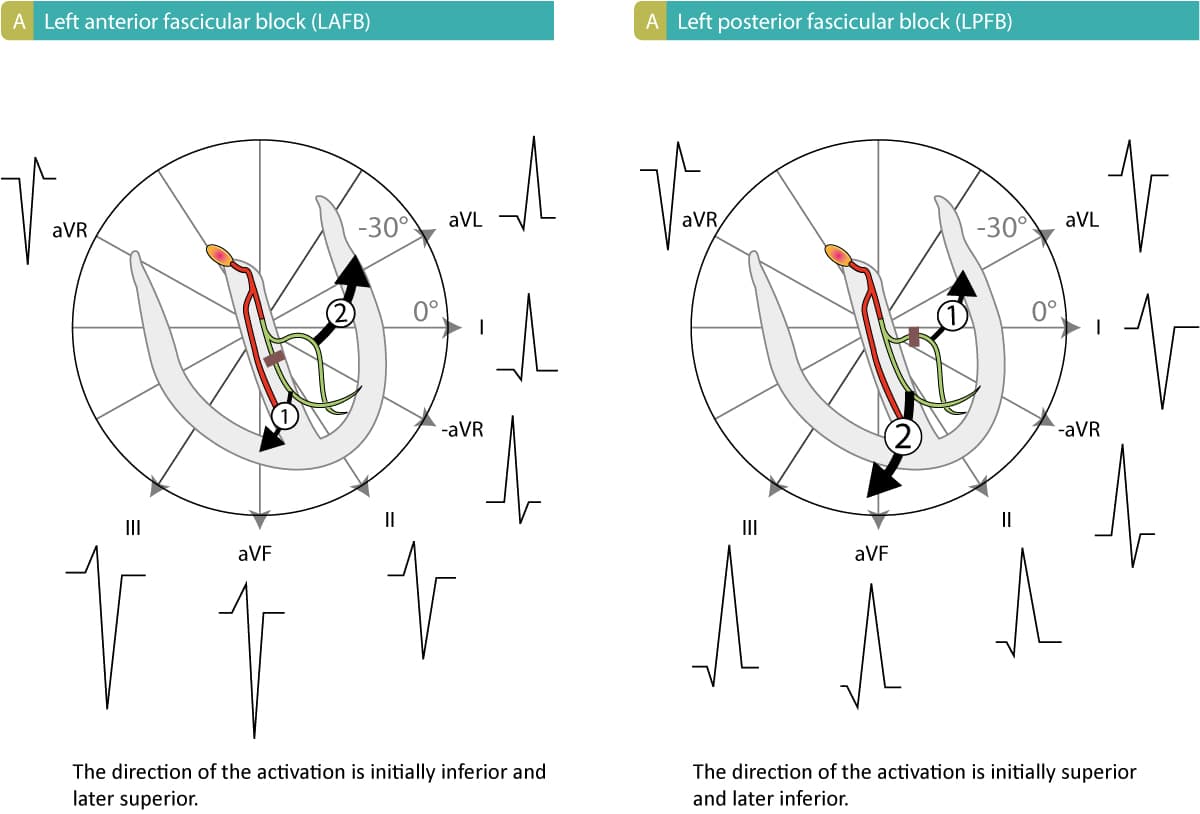Figure 1. Fascicular blocks. – The Cardiovascular