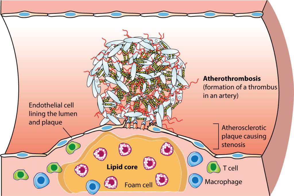 Rupture of atherosclerotic plaque, schematic image – The Cardiovascular