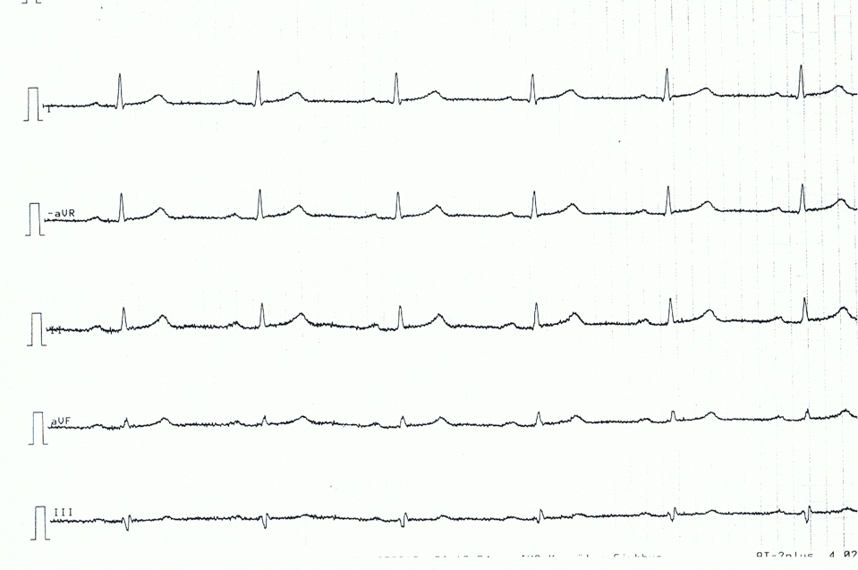 Figure 4. Limb leads of patient with acute pericarditis. Note the very ...