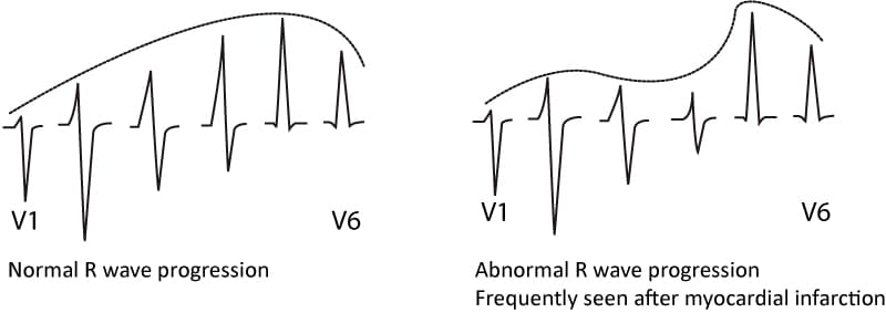R-wave progression – The Cardiovascular