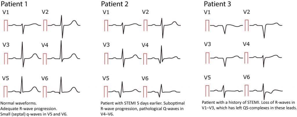 Normal and pathological Q-waves – The Cardiovascular