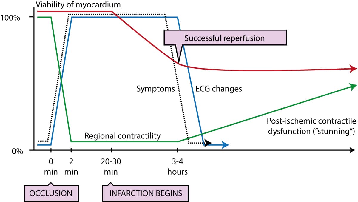Figure 3. Temporal association between coronary artery occlusion ...