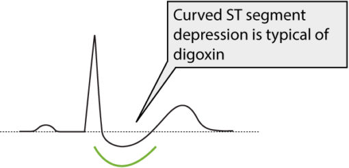Digoxin - ECG changes, arrhythmias, conduction defects & treatment
