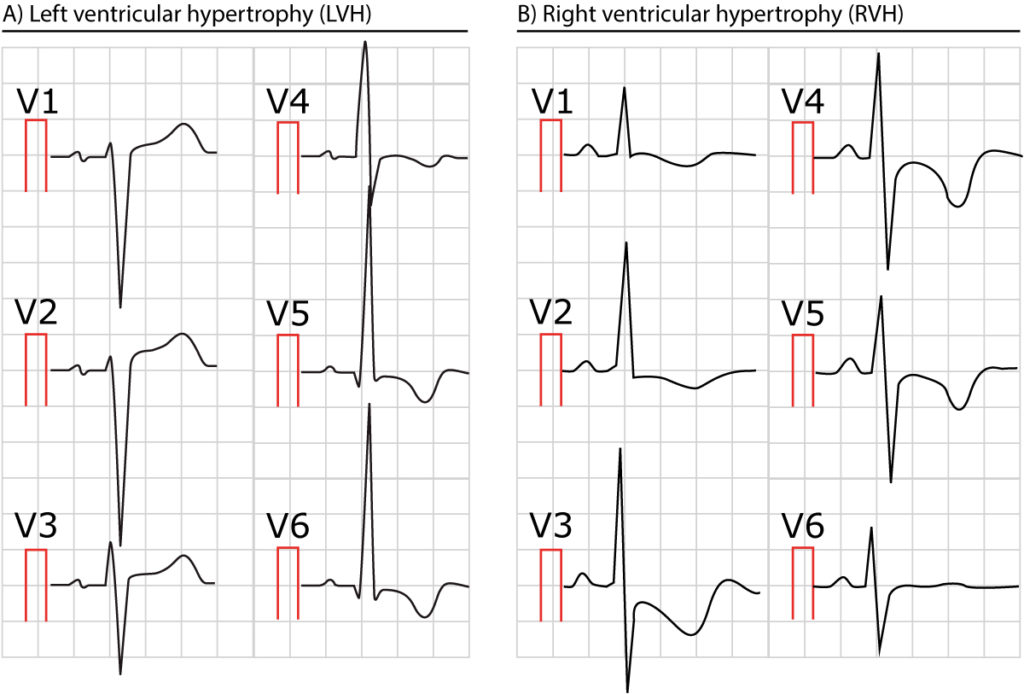 Right ventricular hypertrophy (RVH): ECG criteria & clinical ...
