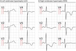 ECG in left ventricular hypertrophy (LVH): criteria and implications