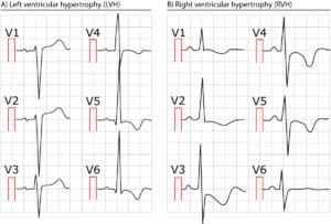 ECG in left ventricular hypertrophy (LVH): criteria and implications