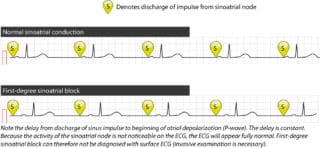 Sinoatrial block (SA block): ECG criteria, causes and clinical features