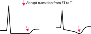 ST segment depression in myocardial ischemia and differential diagnoses