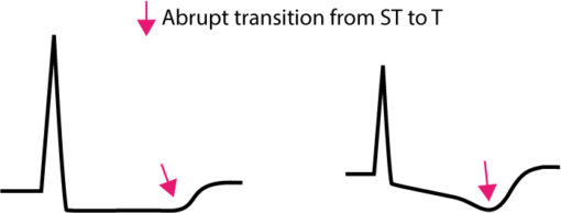 ST segment depression in myocardial ischemia and differential diagnoses