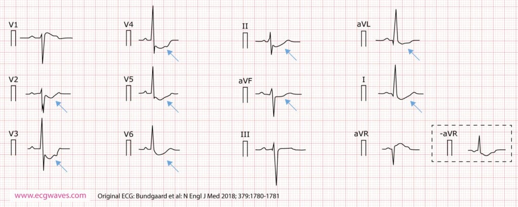 ST segment depression in myocardial ischemia and differential diagnoses