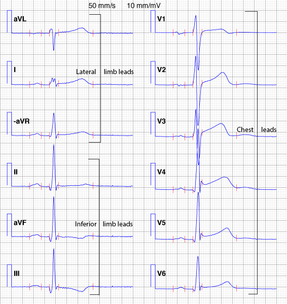 Figure 21. Presentation of the ECG leads according to the Cabrera ...