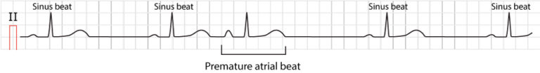 Premature atrial contraction (premature atrial beat / complex): ECG ...