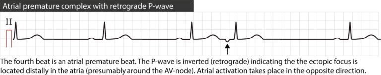 Premature atrial contraction (premature atrial beat / complex): ECG ...