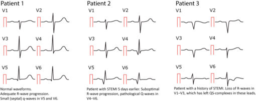 The QRS complex: ECG features of the Q-wave, R-wave, S-wave & duration