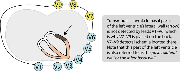 Figure 23. Posterior chest leads may reveal posterior ST-segment ...