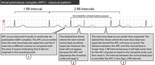 Premature atrial contraction (premature atrial beat / complex): ECG ...