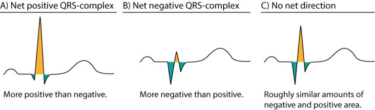 The QRS complex: ECG features of the Q-wave, R-wave, S-wave & duration