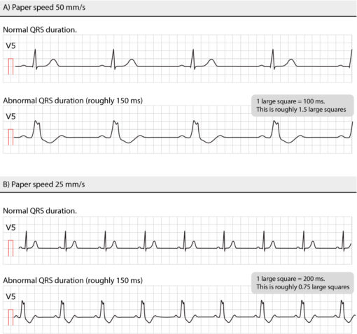 The QRS complex: ECG features of the Q-wave, R-wave, S-wave & duration