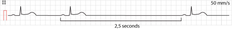 Sinoatrial arrest & sinoatrial pause (sinus pause / arrest)