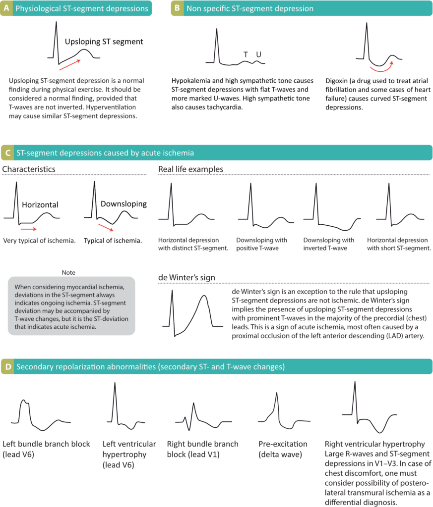 Figure 15. Various causes of ST segment depressions and their ...