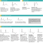 The T-wave: physiology, variants and ECG features
