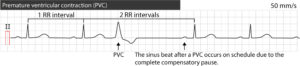 Premature ventricular contractions (premature ventricular complex ...