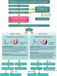 STEMI (ST Elevation Myocardial Infarction): diagnosis, criteria, ECG ...