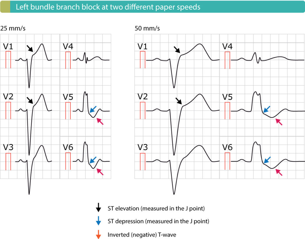 STEMI (ST Elevation Myocardial Infarction): diagnosis, criteria, ECG ...